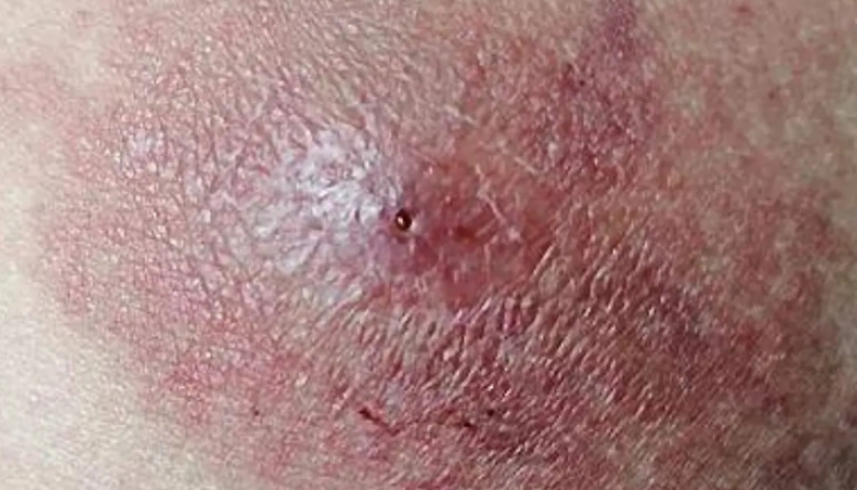 Suman cuatro casos de miasis humana en Chiapas - Diario de Palenque